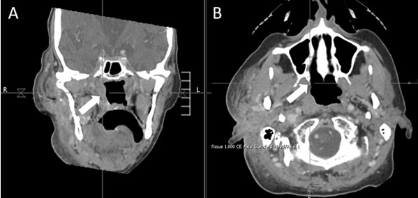 Suppurative parotitis in the setting of methicillin-resistant ...