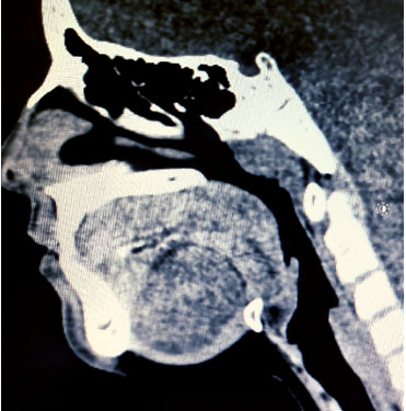 Dermoid cyst presenting as a submental swelling, causing diagnostic ...