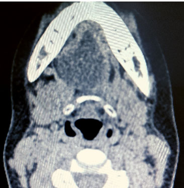 Dermoid cyst presenting as a submental swelling, causing diagnostic ...