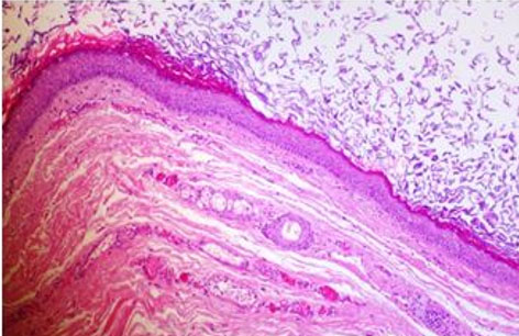 Dermoid cyst presenting as a submental swelling, causing diagnostic ...
