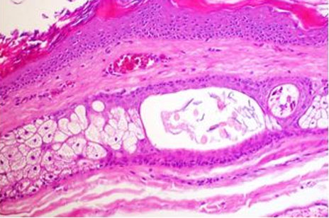 Dermoid cyst presenting as a submental swelling, causing diagnostic ...
